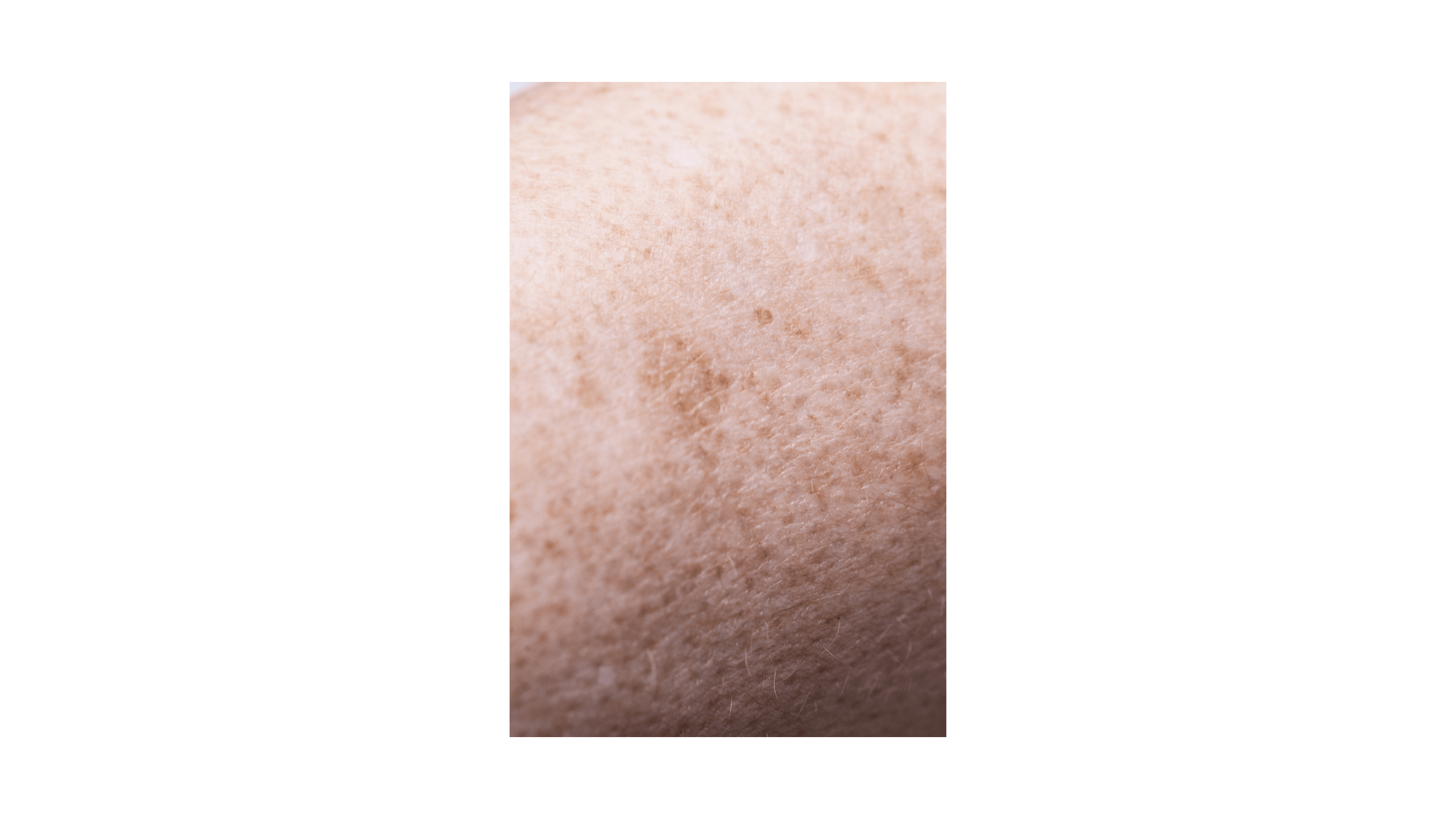 Hyperpigmentation | Queen Bee Salon & Spa